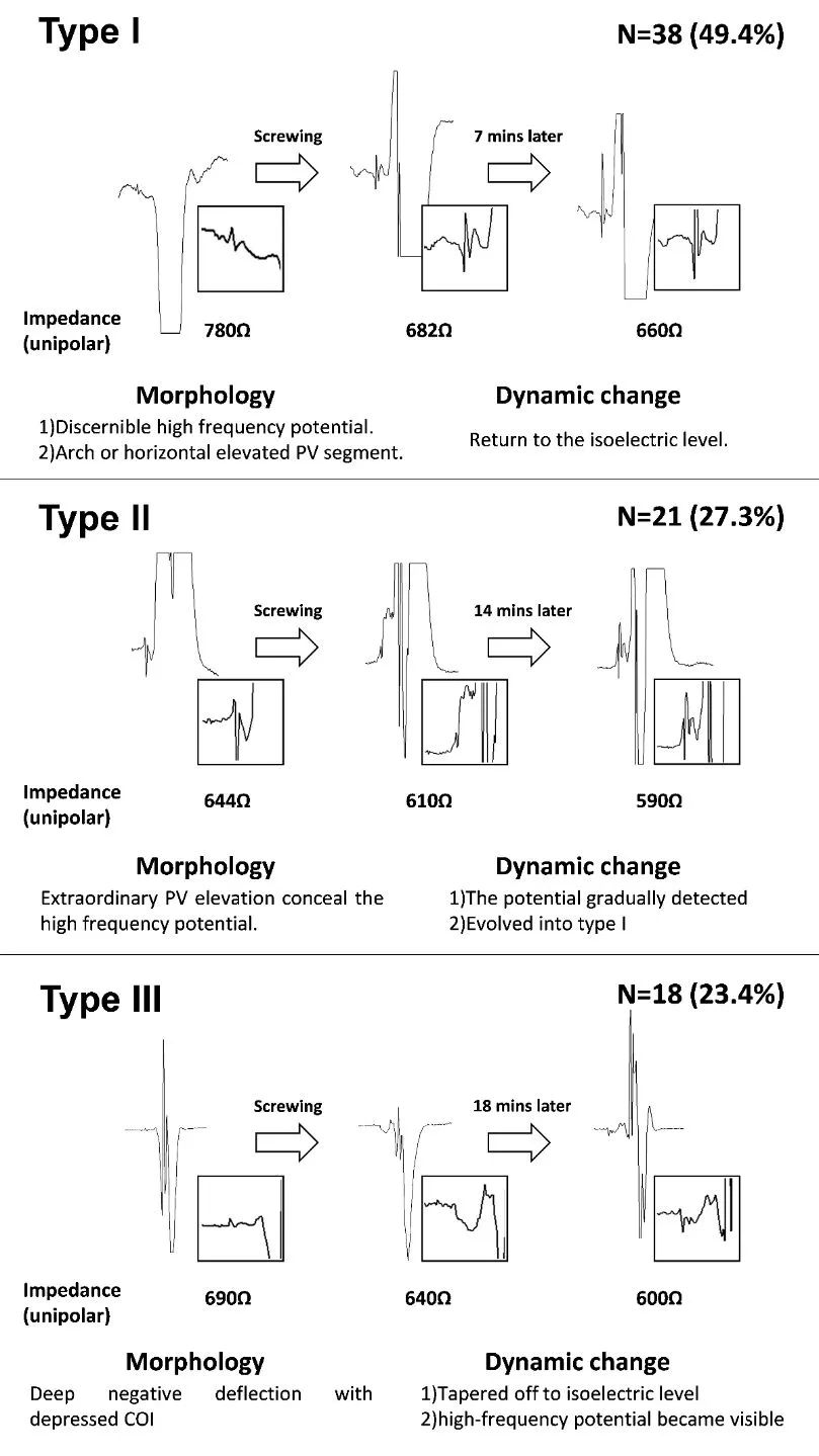 LBBP术中损伤电流的特征及临床价值