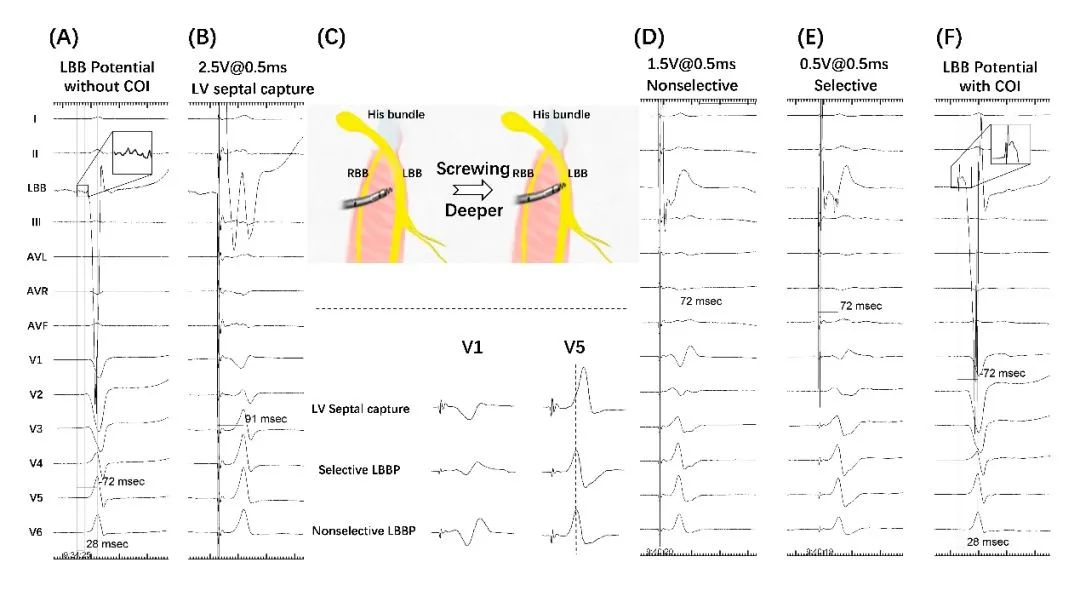 LBBP术中损伤电流的特征及临床价值