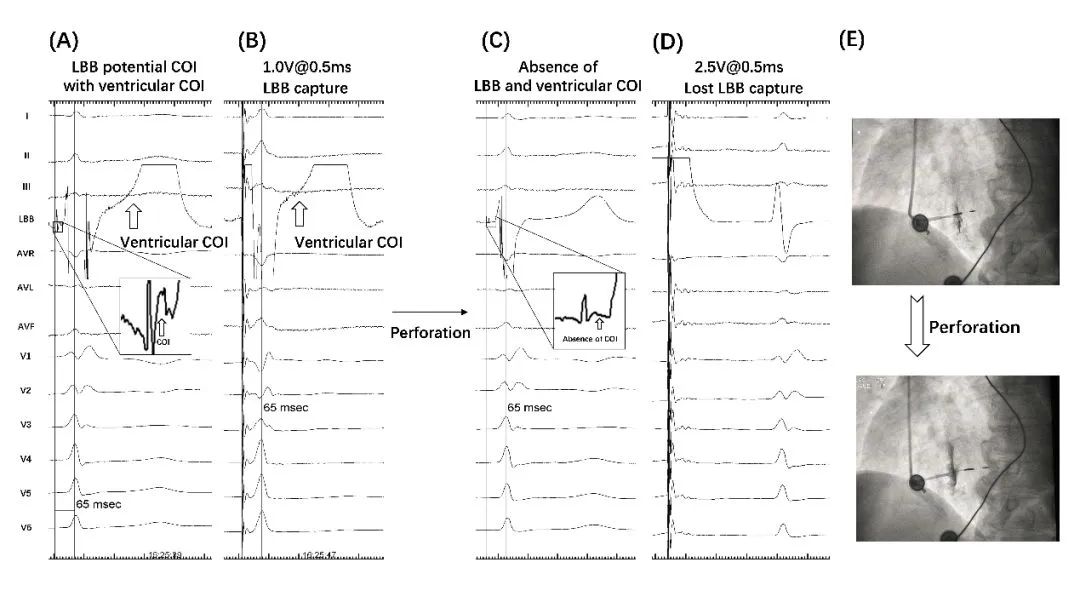 LBBP术中损伤电流的特征及临床价值